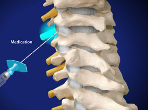 Selective Nerve Root Block - Advanced PainCare, Dr. Michael Fishell