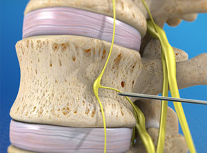 Lumbar Sympathetic Block - Advanced PainCare, Dr. Michael Fishell